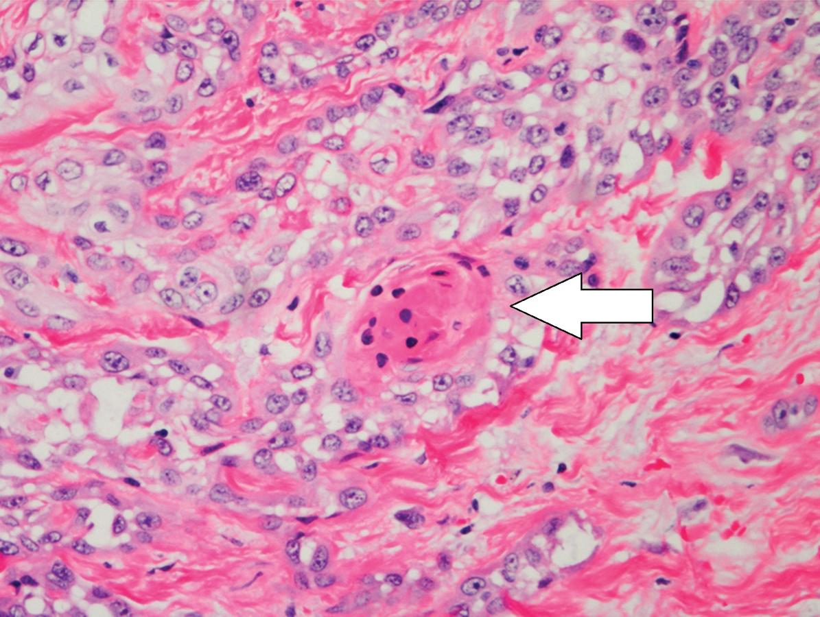 File Micrograph Of Clear Cell Squamous Cell Carcinoma With Focus Of